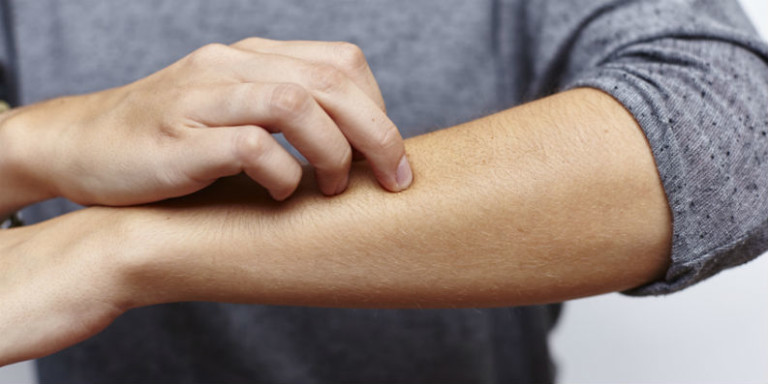 Basiswissen Atopische Dermatitis: Stigmata - allergie.de
